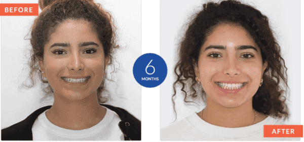 Brava By BRIUS | SmileHaus Orthodontist