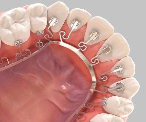 Revolutionizing Orthodontics: An In-depth Look at BRAVA by Brius ...