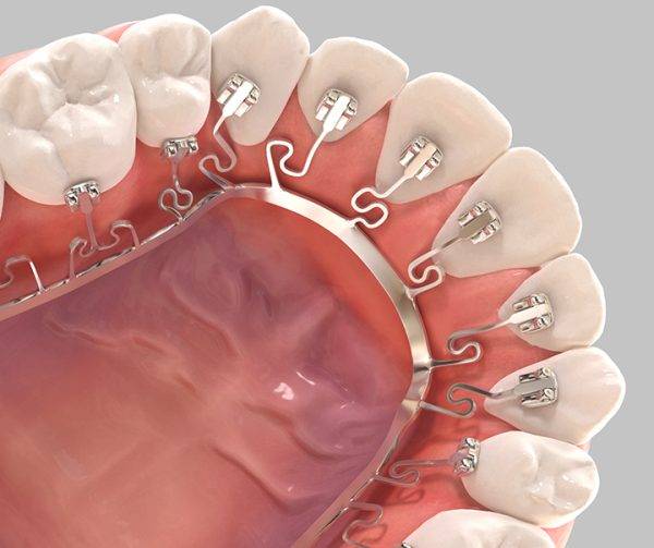 Revolutionizing Orthodontics: An In-depth Look at BRAVA by Brius ...