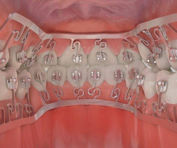Revolutionizing Orthodontics: An In-depth Look at BRAVA by Brius ...